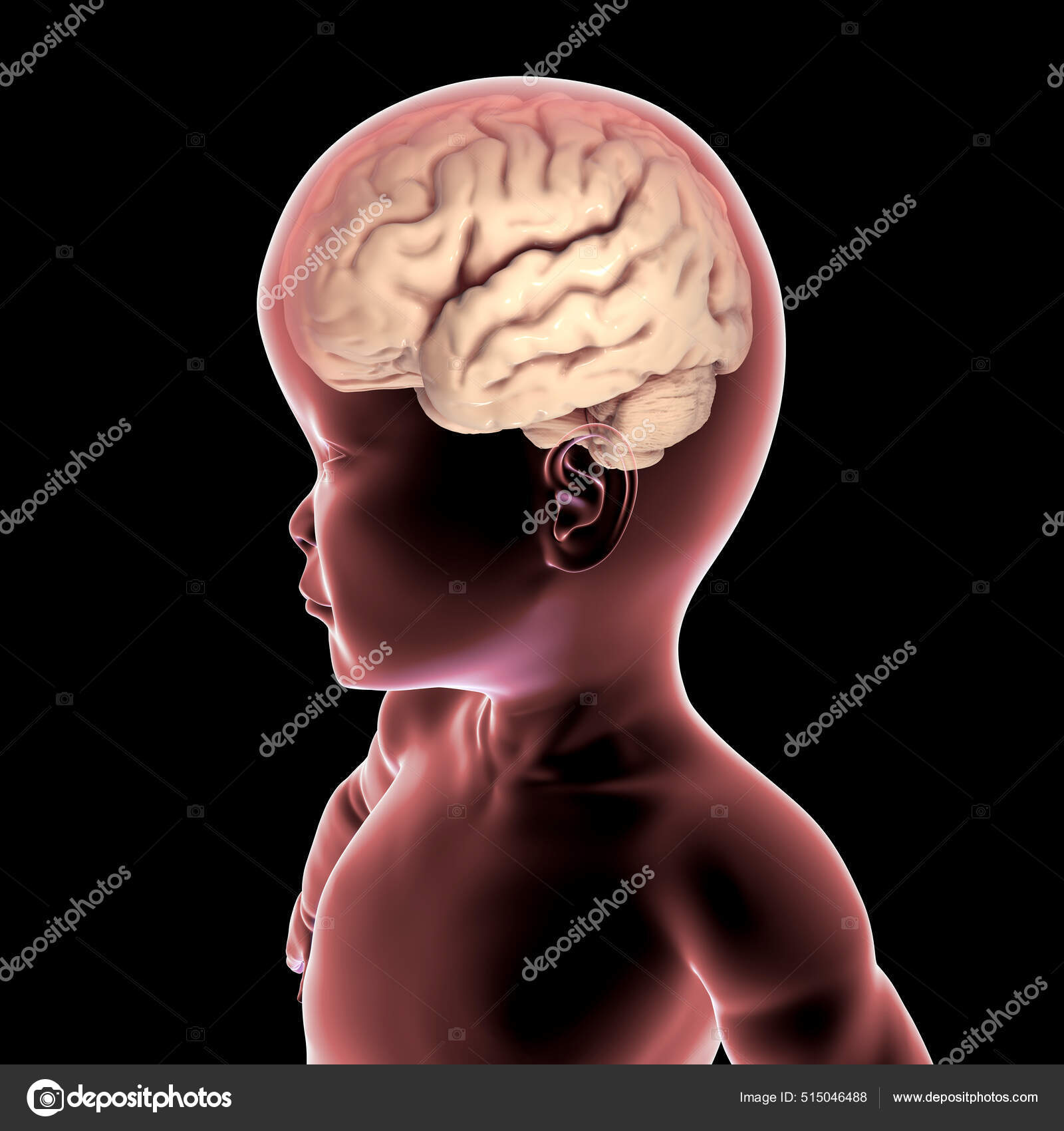 Megalencephaly Syndrome Hemimegalencephaly | Radiology Case ...