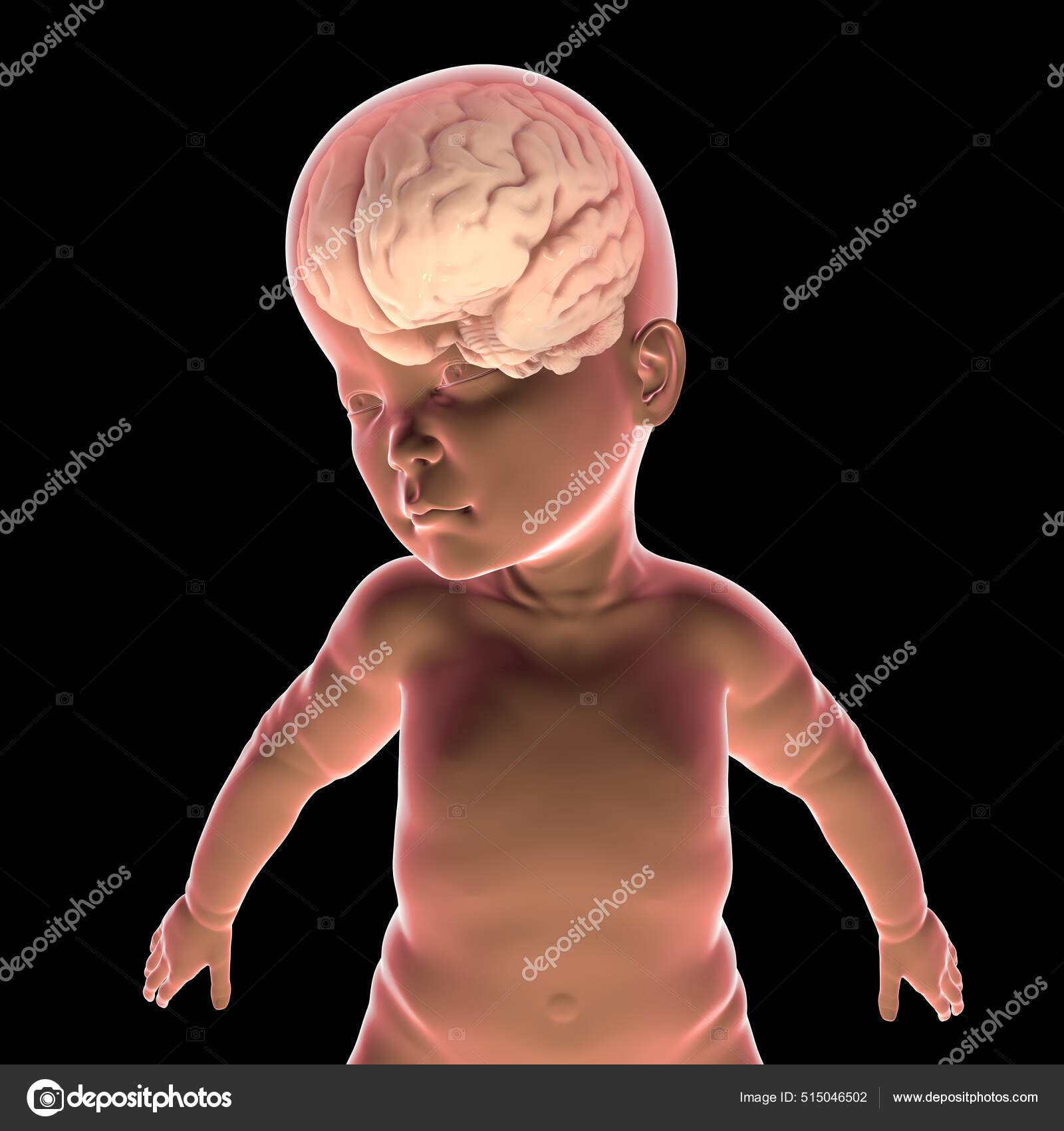 Macrocefalie Autisme Autisme Spectrum Stoornissen Ppt Download