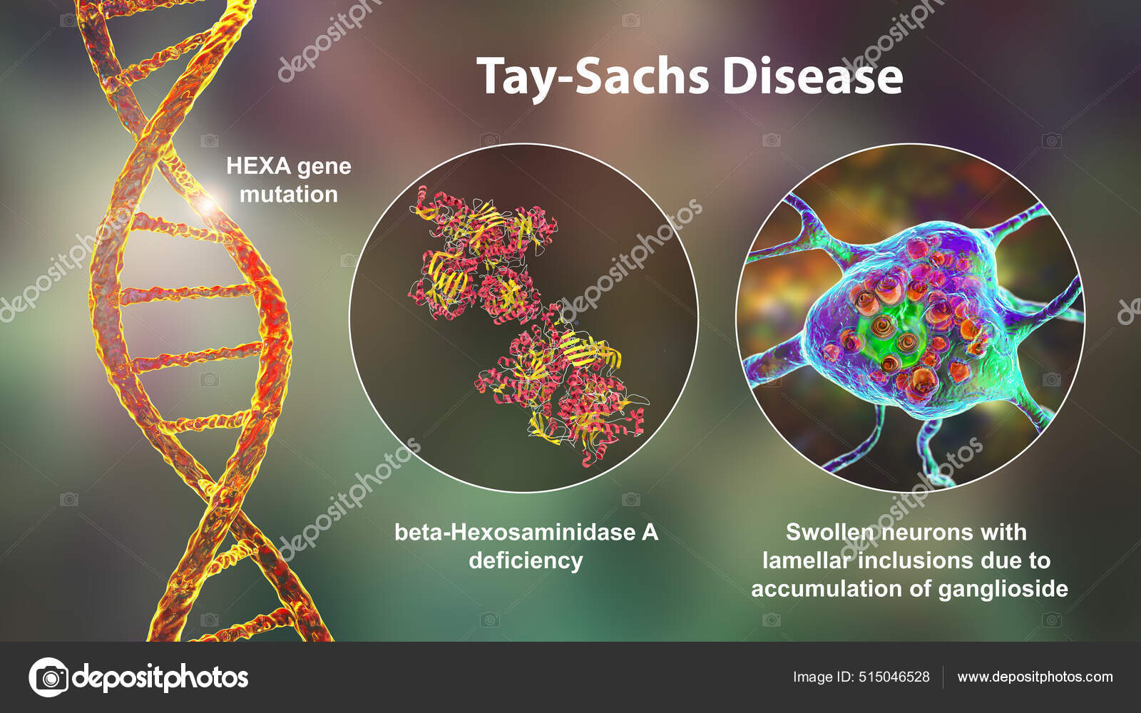 Tay Sachs Disease Illustration Genetic Disorder Progressively Destroys ...