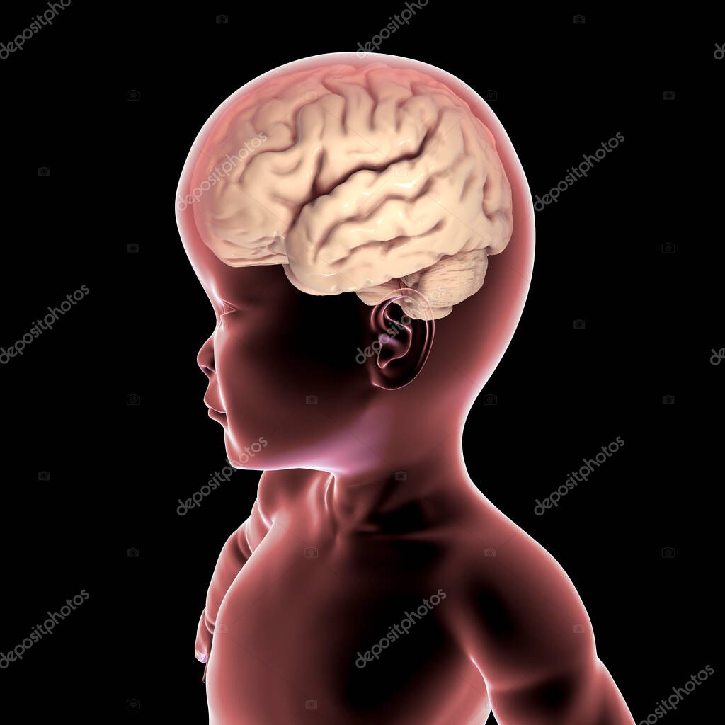 Un niño con macrocefalia y cerebro agrandado, ilustración 3D ...