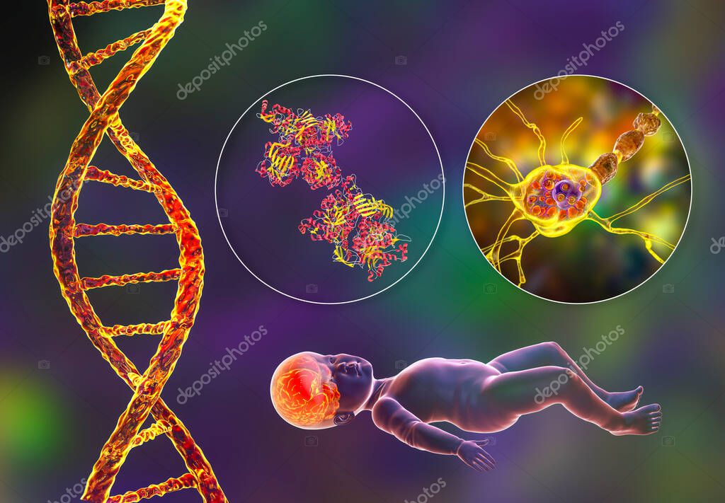 Enfermedad de Tay-Sachs, un trastorno genético de almacenamiento ...