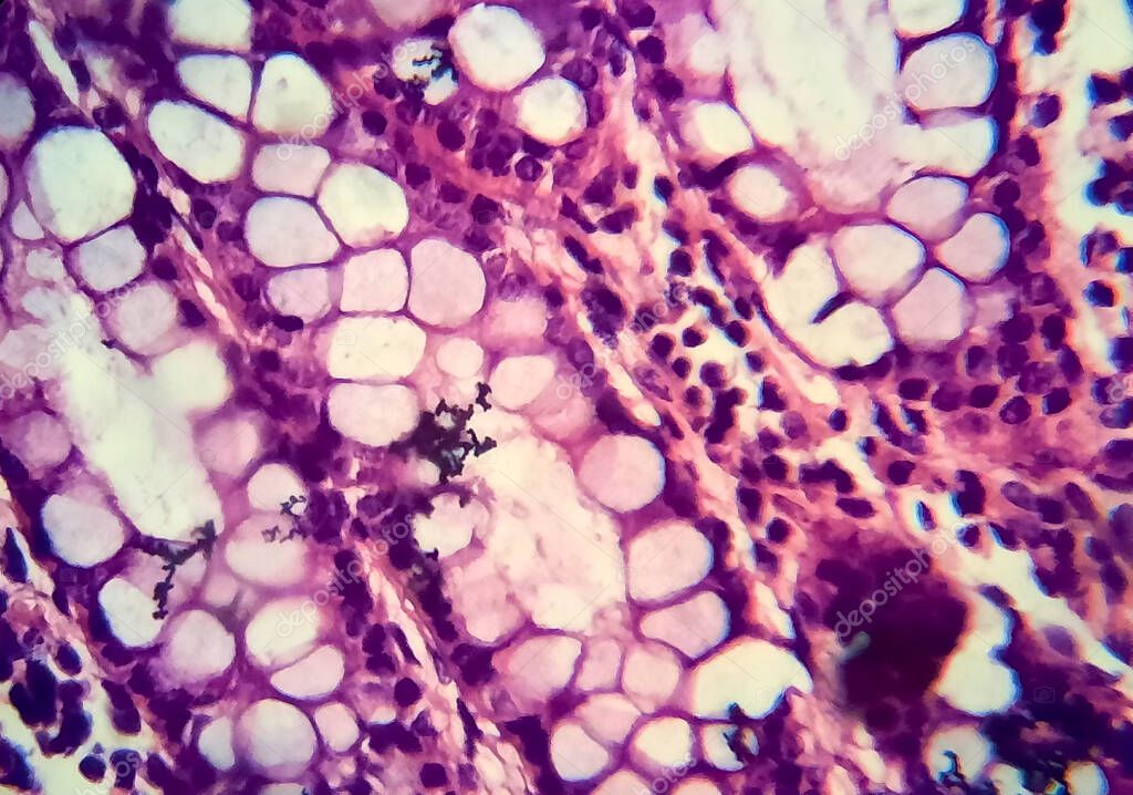 Disentería bacilar, micrografía ligera, foto bajo microscopio que ...