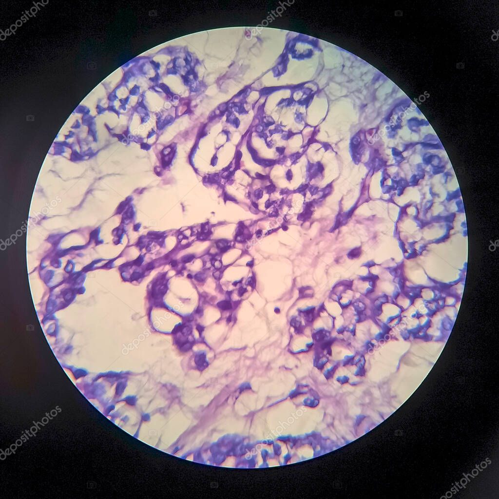 Carcinoma folicular tiroideo, micrograf a ligera, foto bajo microscopio ...