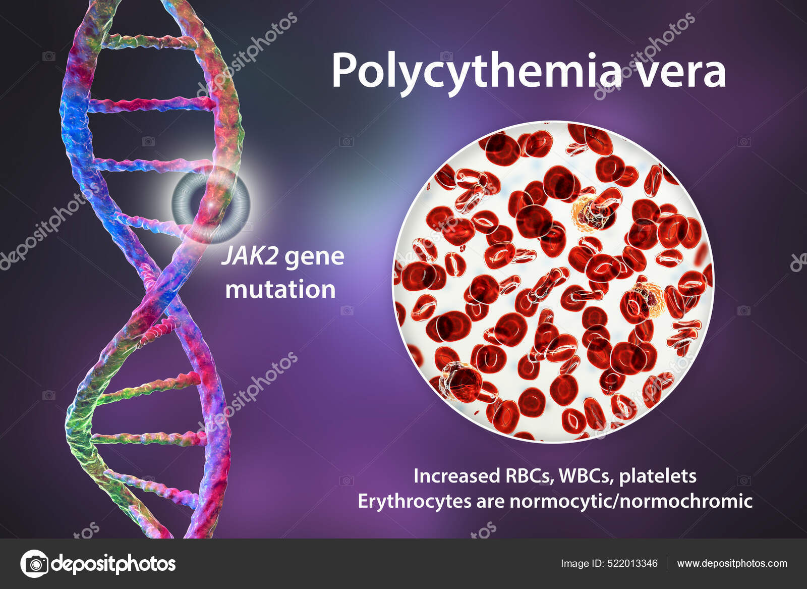 Polycythemia Vera Rare Blood Cancer Increase Number Red Blood Cells ...