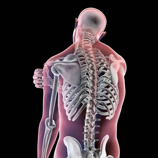 Shoulder Pain Conceptual Illustration Set Human Bodies Skeleton Painful ...