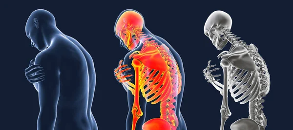 Scoliosis Illustration Human Body Curved Spine Uneven Shoulders Hips ...