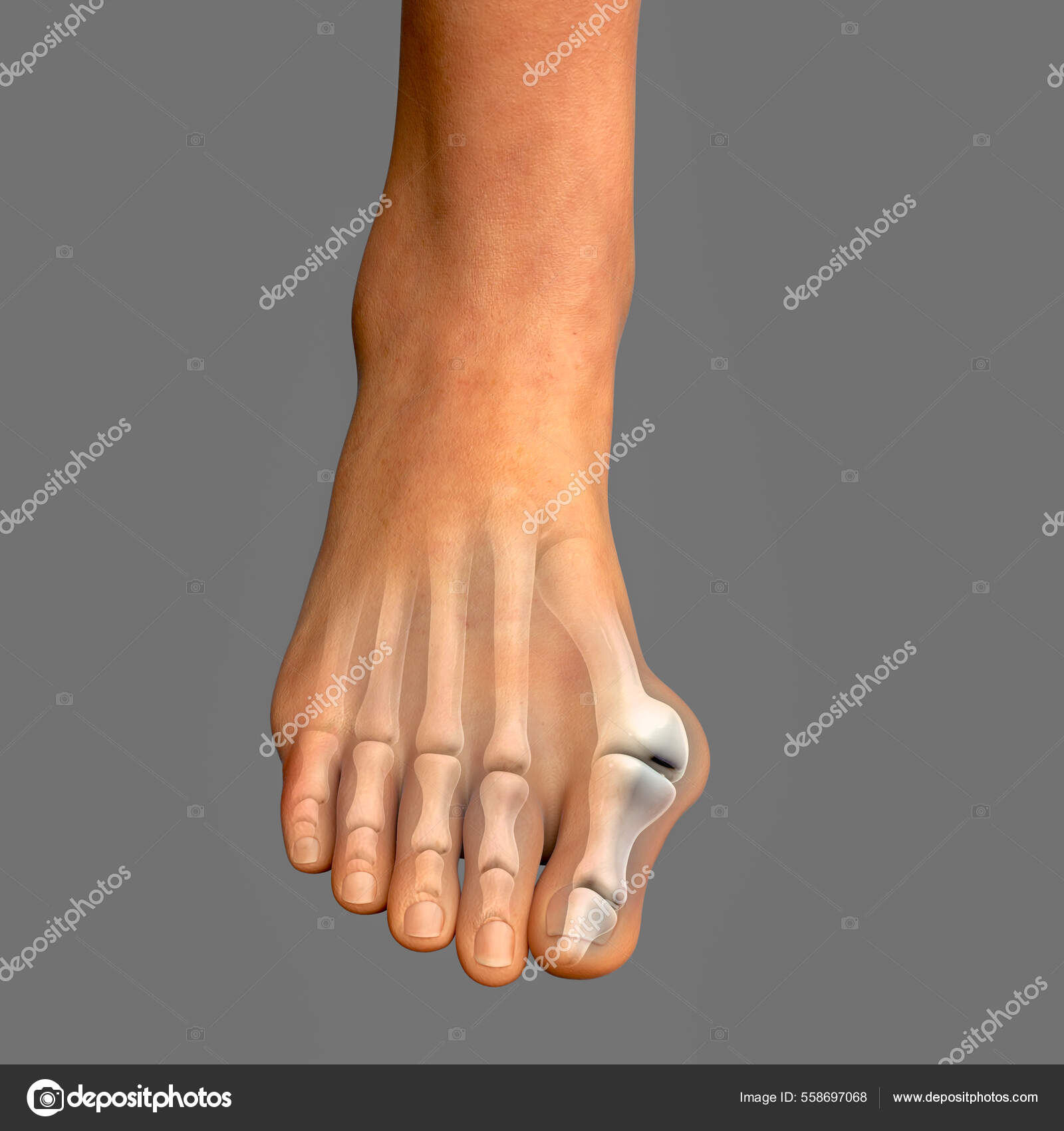 Toe Deformation Also Known Hallux Valgus Bunion Illustration Stock ...