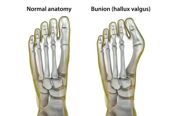 Deformación del dedo del pie, también conocida como hallux valgus, o ...