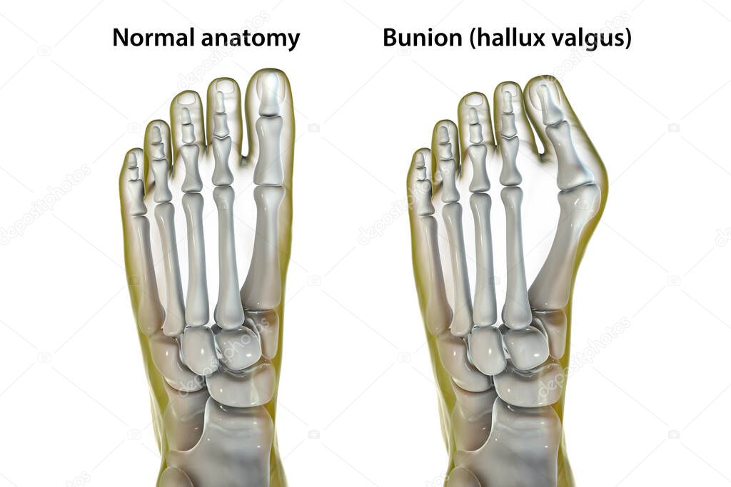 Deformación del dedo del pie, también conocida como hallux valgus, o juanete, ilustración 3D que ...