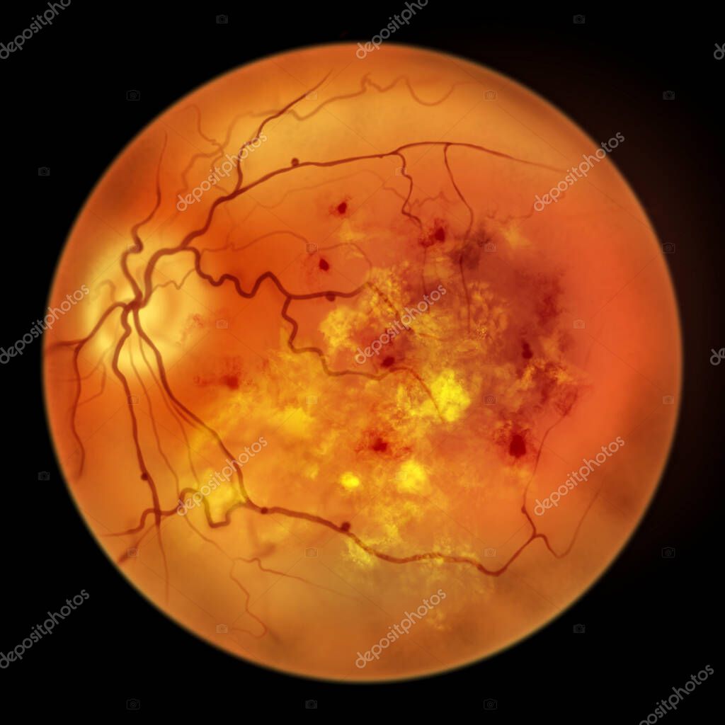 Retinopatía Diabética Vista Oftalmoscópica Ilustración Que Muestra