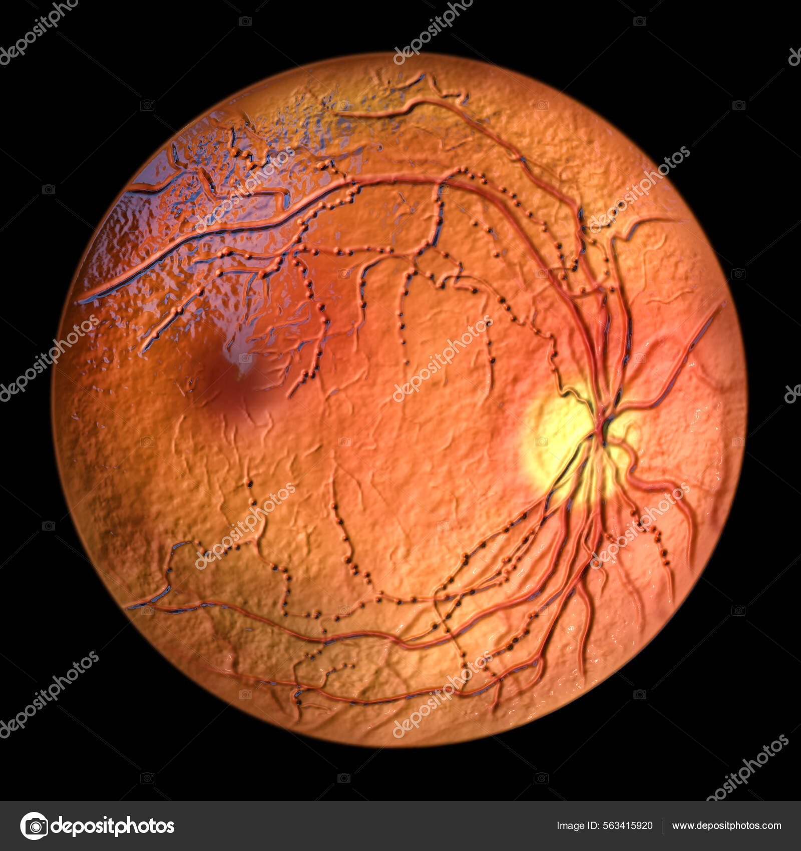 Diabetic Retinopathy Background Clinical Form Microaneurysms ...