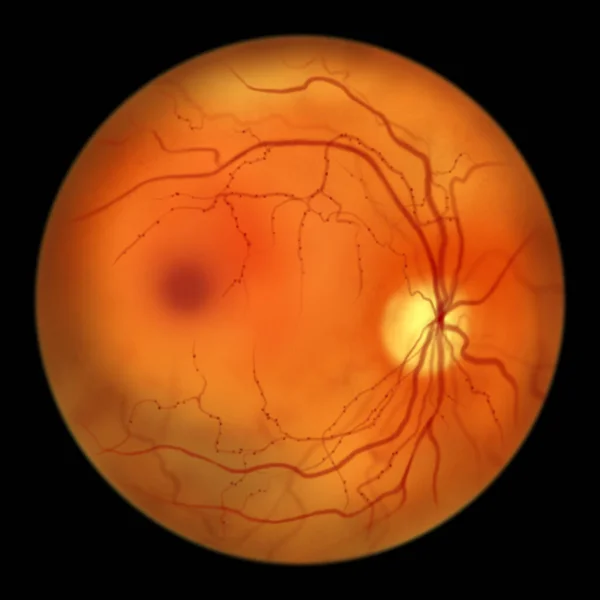 Non Proliferative Diabetic Retinopathy Illustration Showing Venous ...