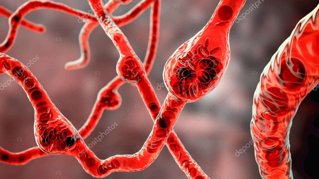 Microaneurismas, bultos microsc picos en las paredes arteriales llenas de sangre, ilustraci n 3D ...