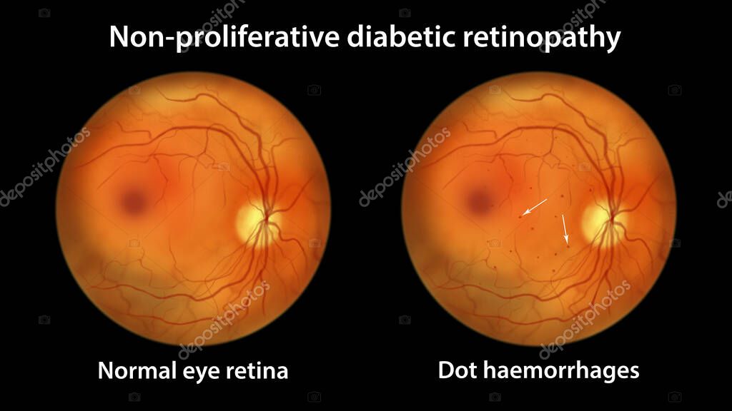 Retinopatía Diabética No Proliferativa Vista Oftalmoscópica