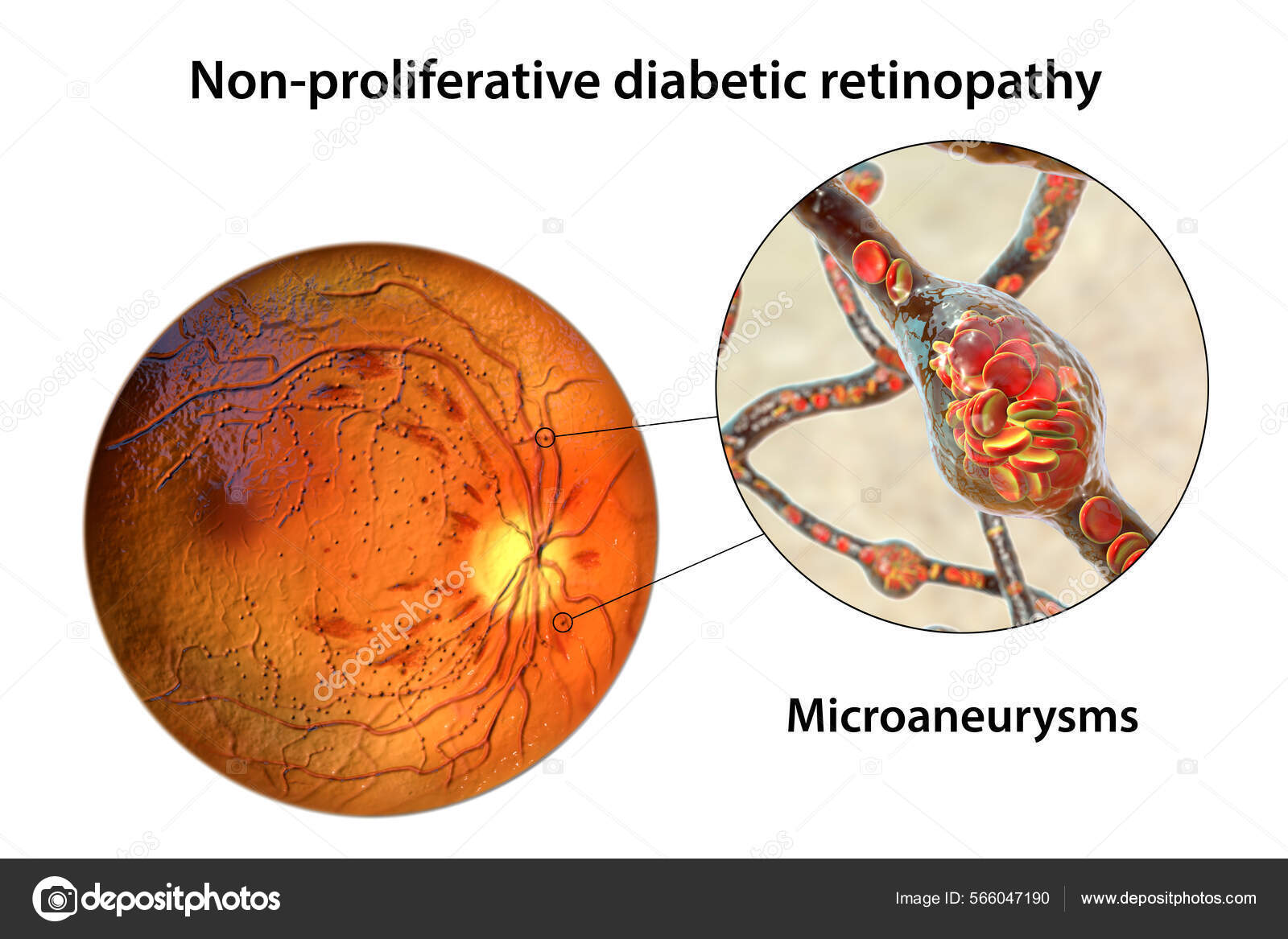 Non Proliferative Diabetic Retinopathy Illustration Showing Multiple ...