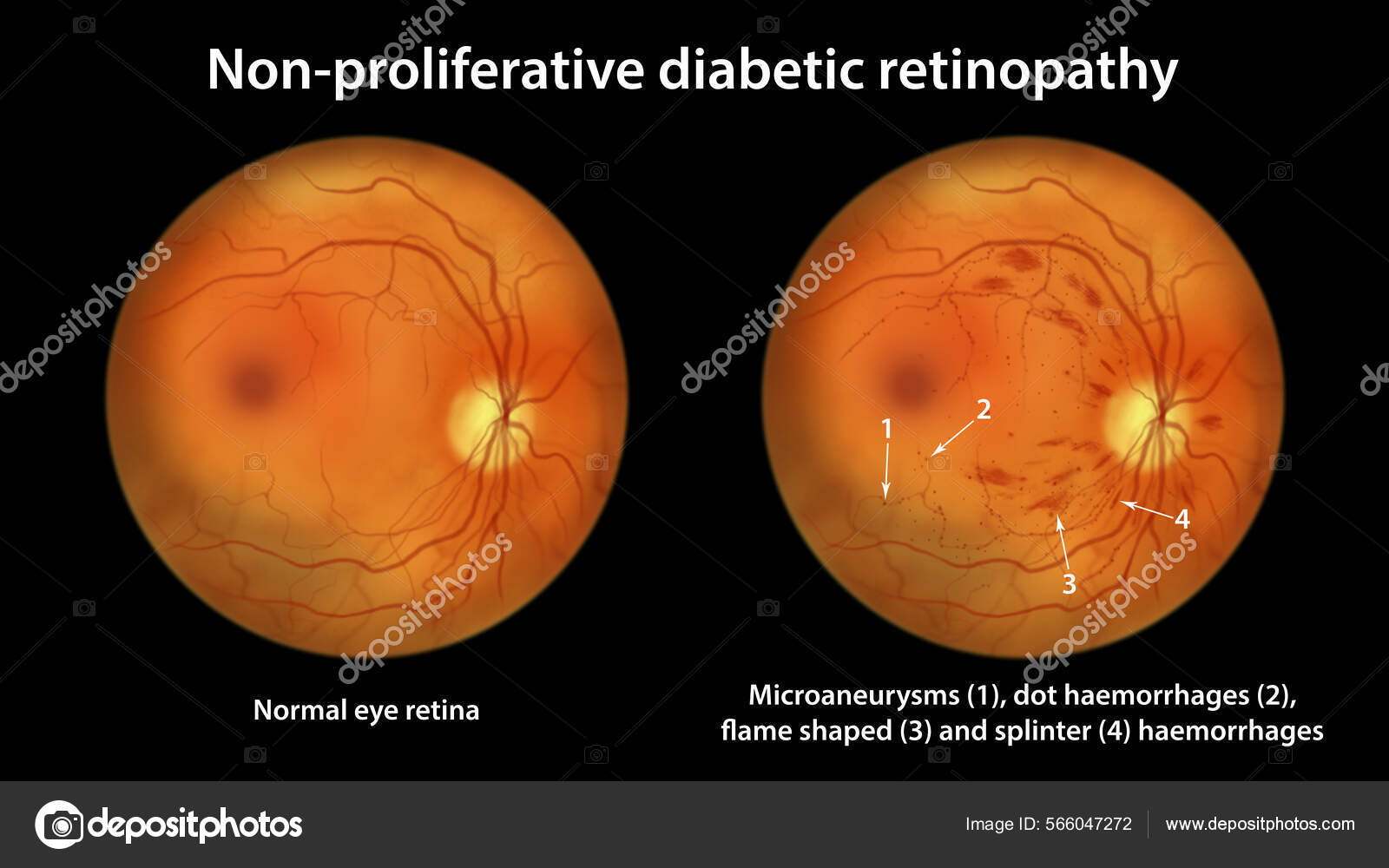Non Proliferative Diabetic Retinopathy Illustration Showing Normal Eye ...