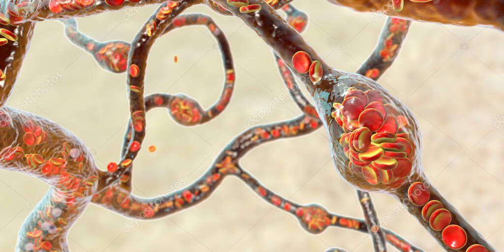 Microaneurismas, bultos microscópicos en las paredes arteriales llenas ...