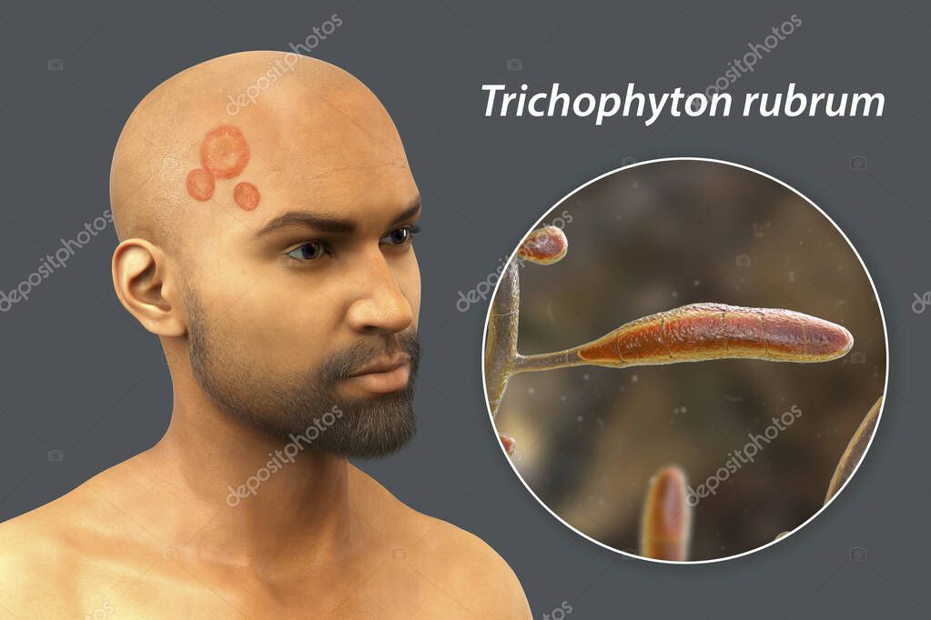 Fungal infection on a man's head and face, 3D illustration of a man ...