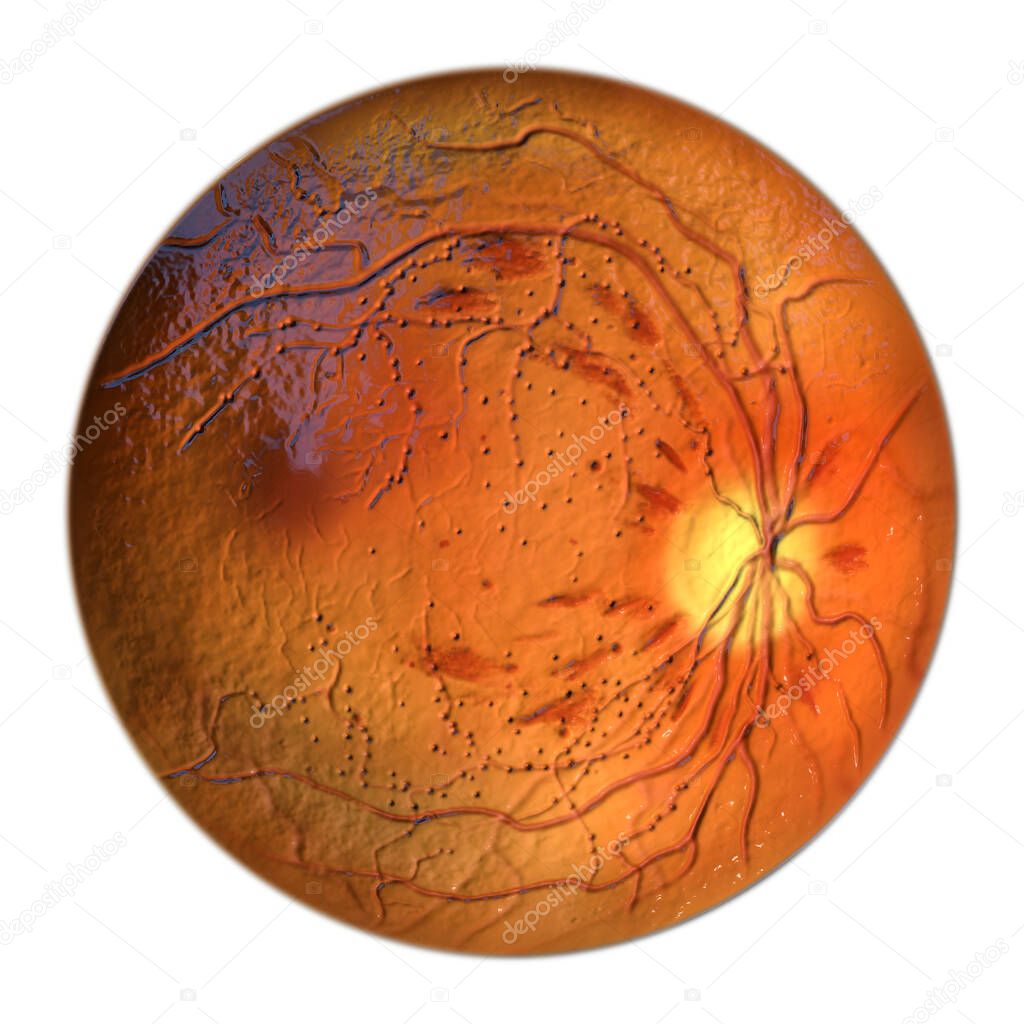 Non-proliferative diabetic retinopathy, 3D illustration showing ...