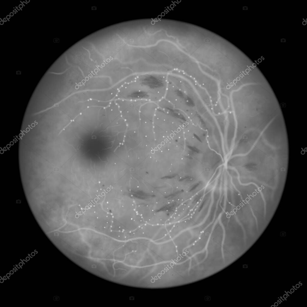 Non-proliferative diabetic retinopathy, illustration showing ...