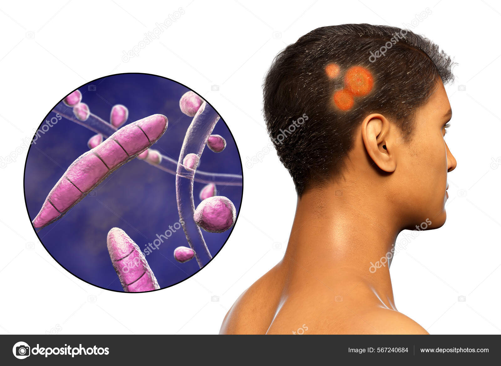 Fungal Infection Man's Head Illustration Man Tinea Capitis Close View ...