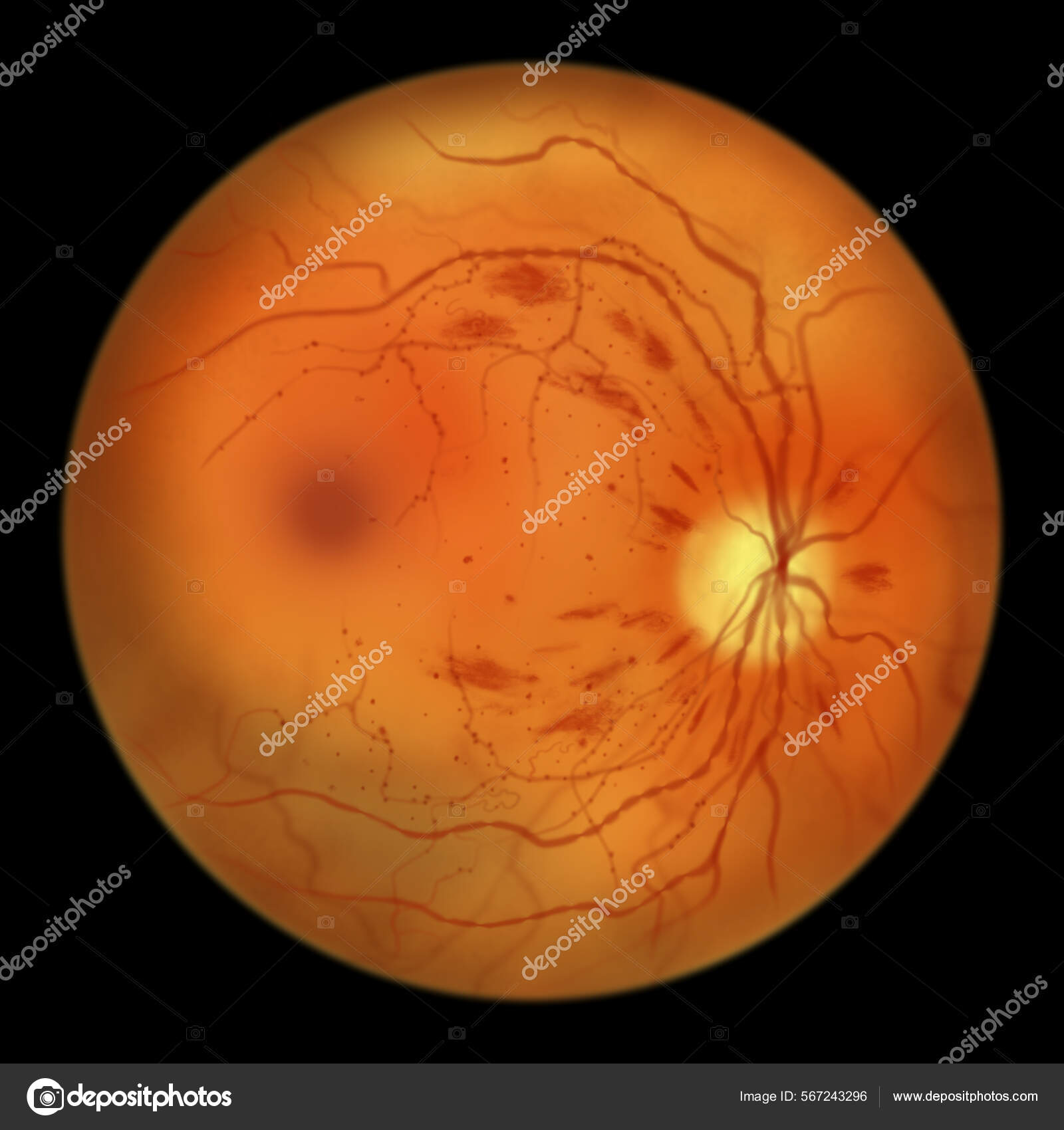 Non Proliferative Diabetic Retinopathy Illustration Showing Irmas ...