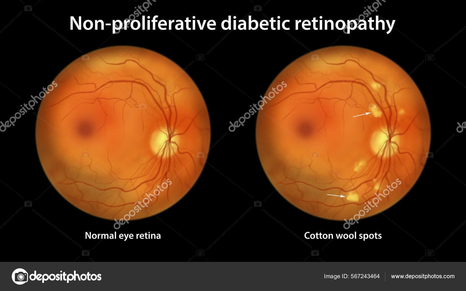 Non Proliferative Diabetic Retinopathy Illustration Showing Normal Eye ...