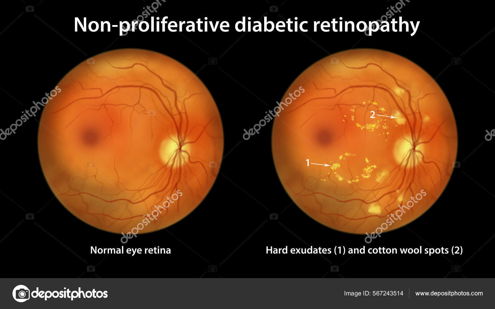 Non Proliferative Diabetic Retinopathy