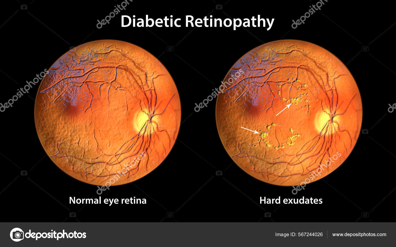Non Proliferative Diabetic Retinopathy Illustration Showing Normal Eye ...
