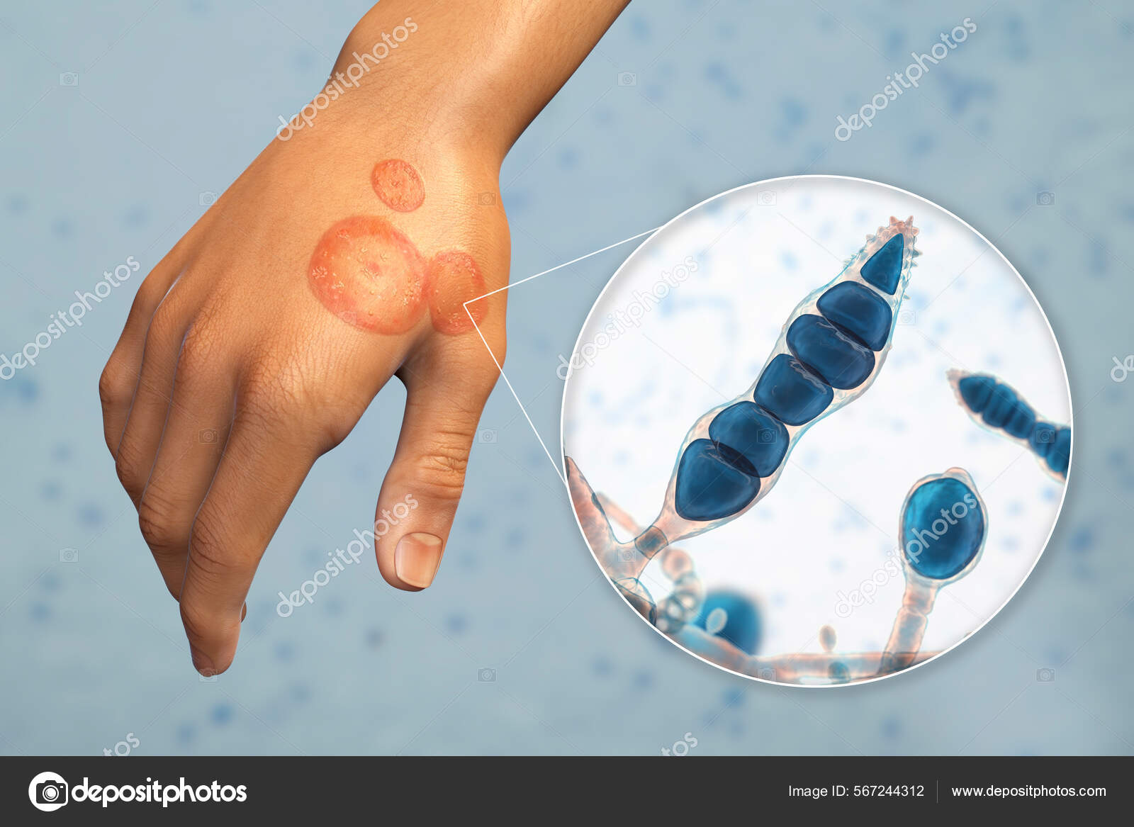 Fungal Infection Man's Hand Tinea Manuum Close View Dermatophyte Fungi ...
