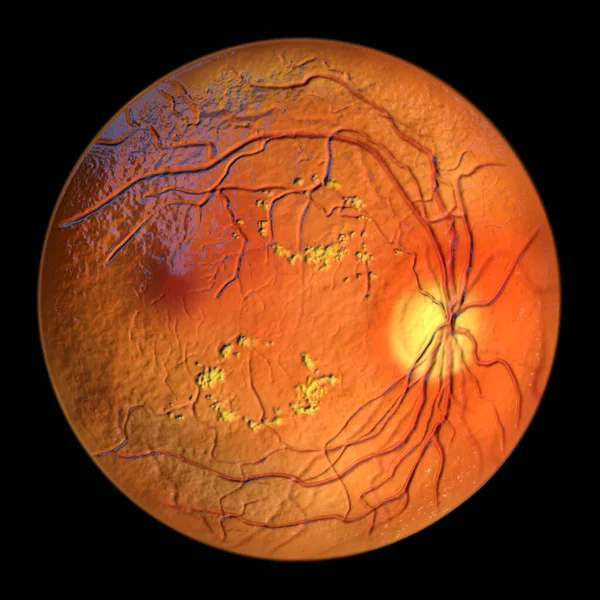Diabetic Retinopathy Background Clinical Form Microaneurysms ...