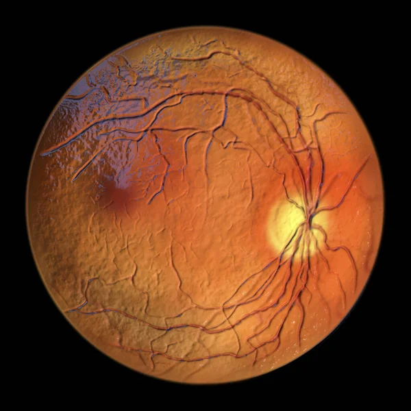 Nonproliferative Diabetic Retinopathy With Macular Edema