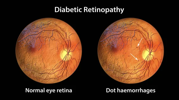 Non Proliferative Diabetic Retinopathy Ophthalmoscope View Illustration ...