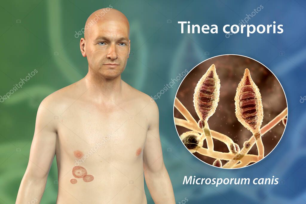 Infección fúngica en el cuerpo de un hombre. Tinea corporis y vista de ...
