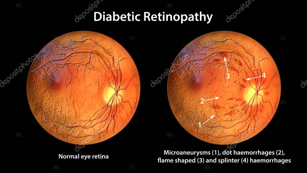 Retinopatía diabética no proliferativa, ilustración 3D que muestra ...