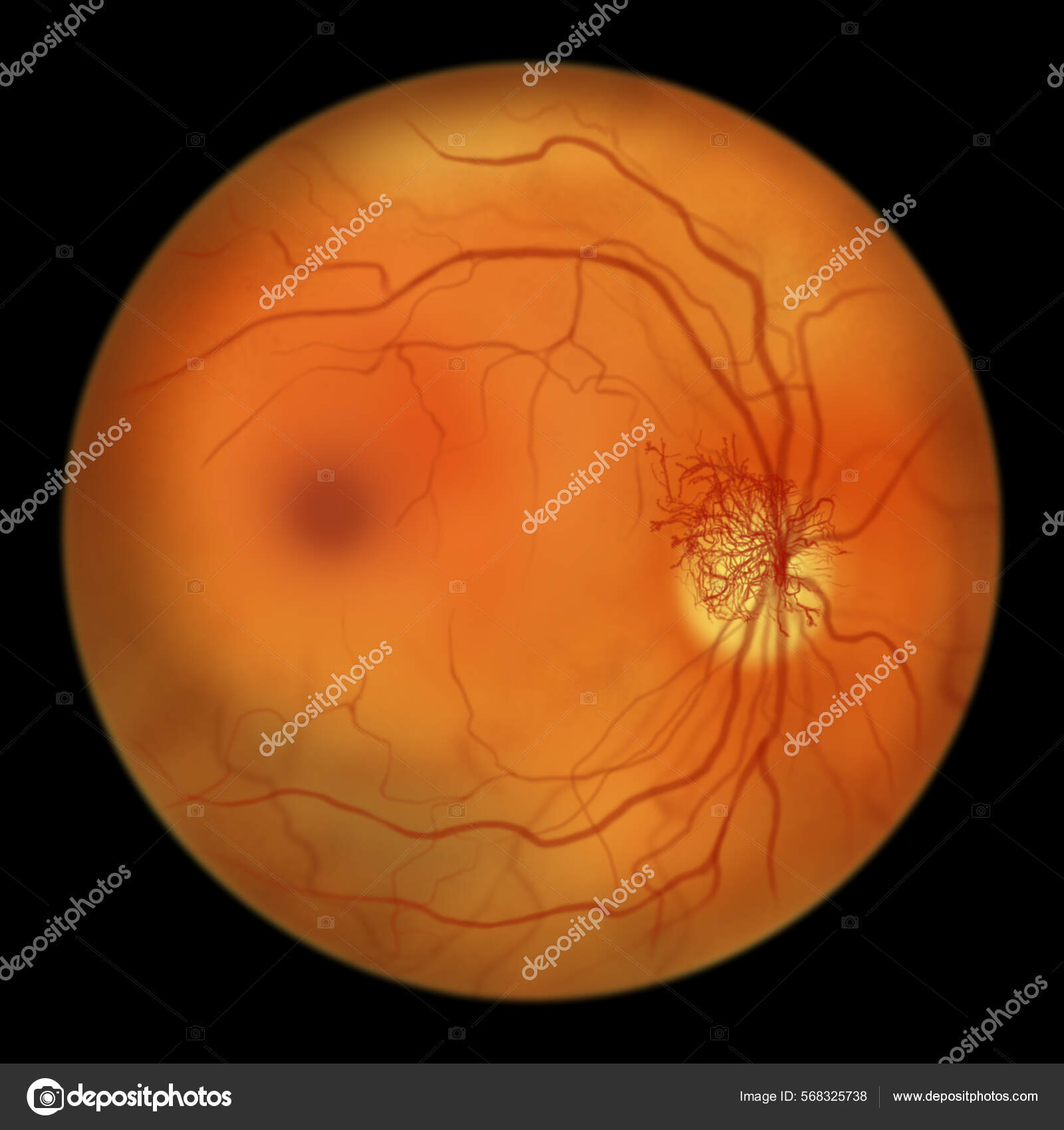 Proliferative Diabetic Retinopathy Illustration Showing ...
