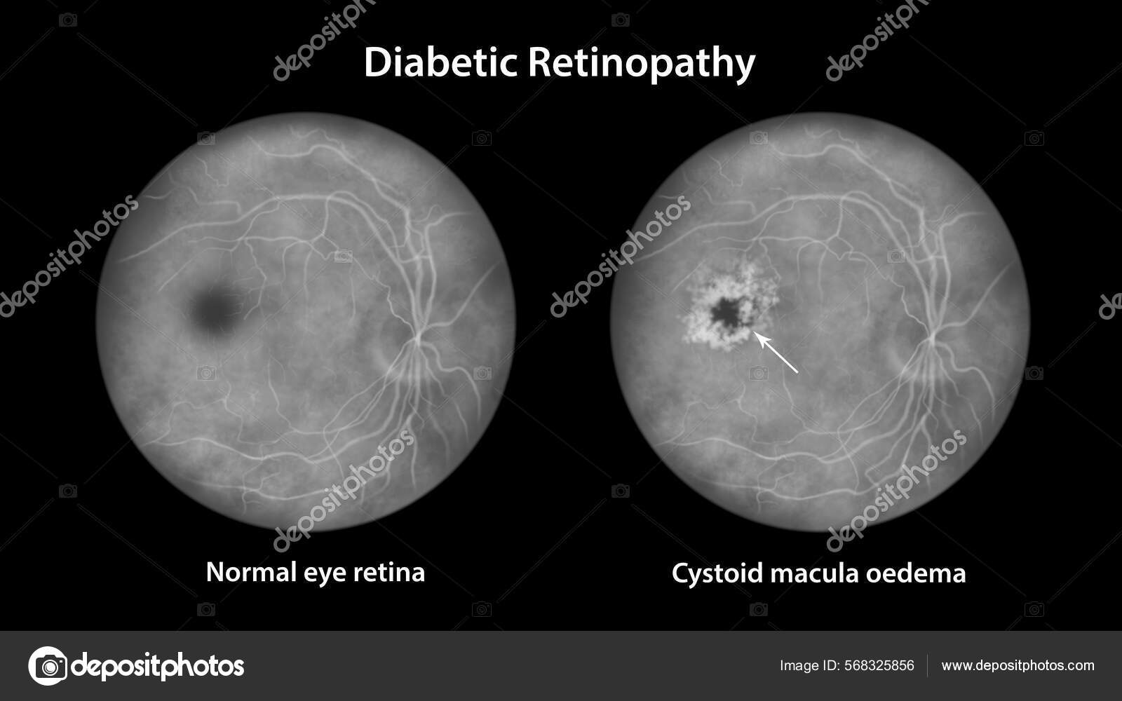 Diabetic Macular Edema Fluorescein Angiography