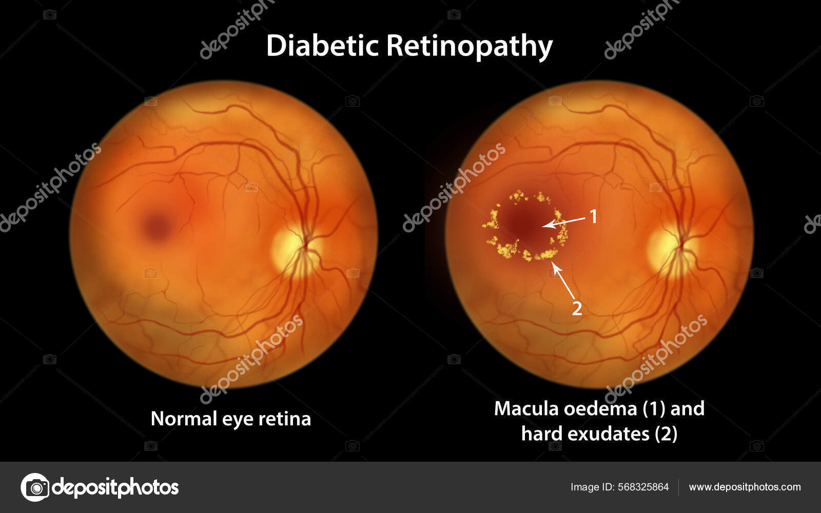 Diabetic Retinopathy Illustration Showing Macula Edema Hard Exudates ...