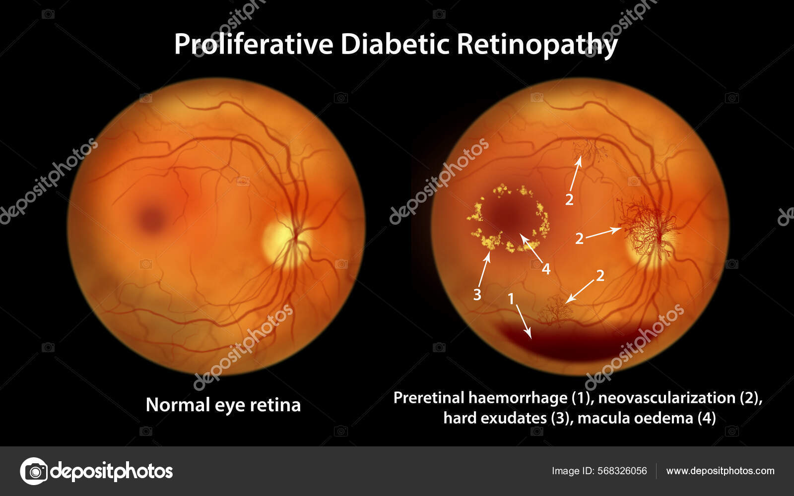 Proliferative Diabetic Retinopathy Illustration Showing Preretinal ...