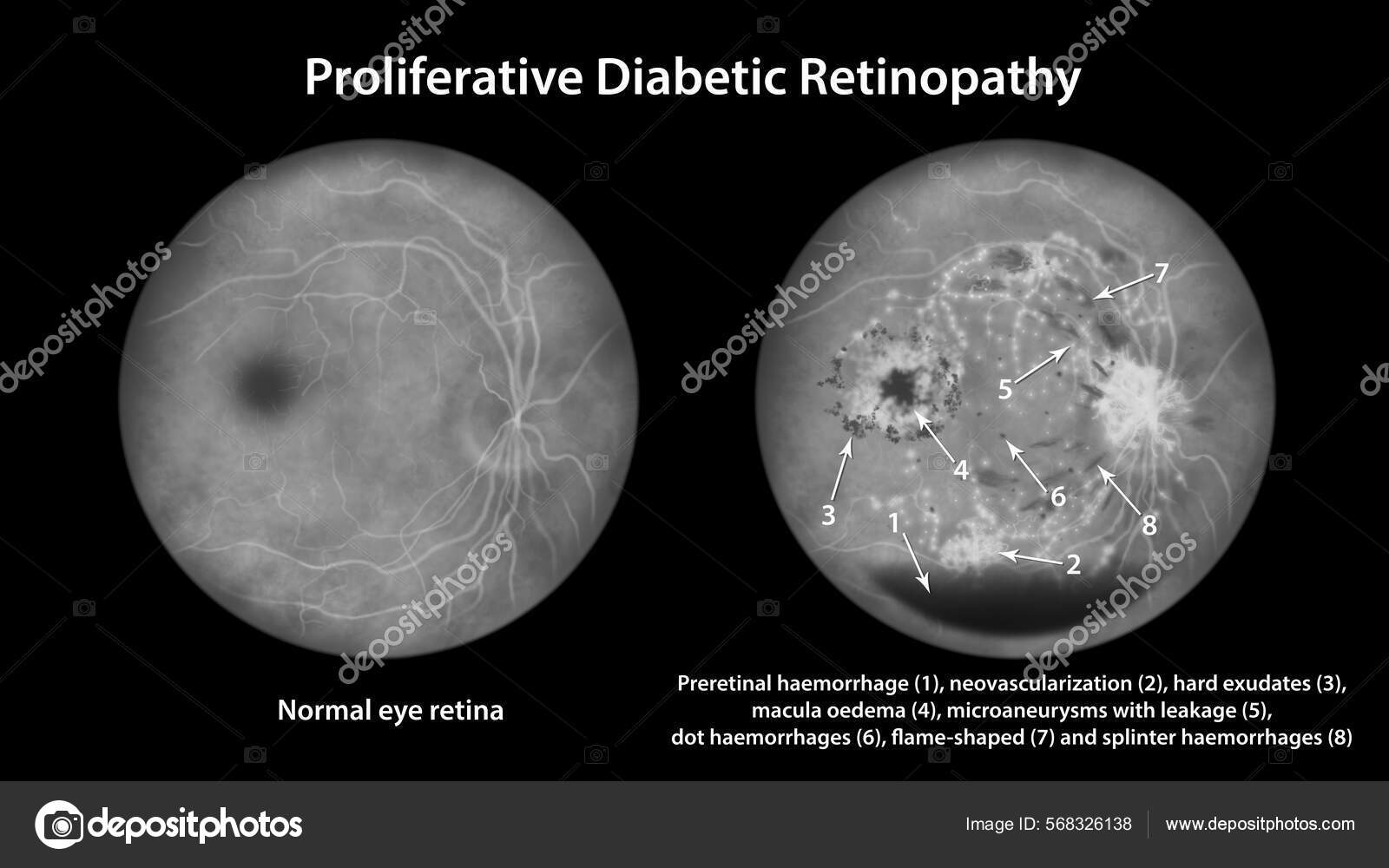 Proliferative Diabetic Retinopathy