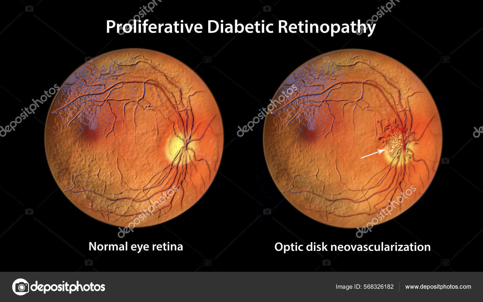 Proliferative Diabetic Retinopathy Illustration Showing Neovascularization Formation New Vessels ...