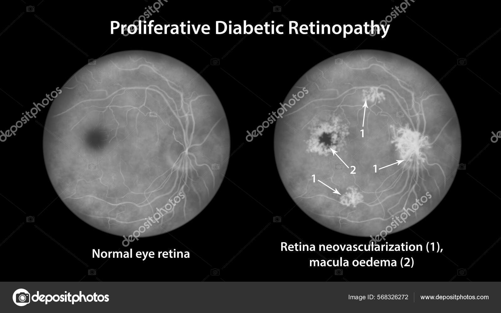 Proliferative Diabetic Retinopathy Neovascularization