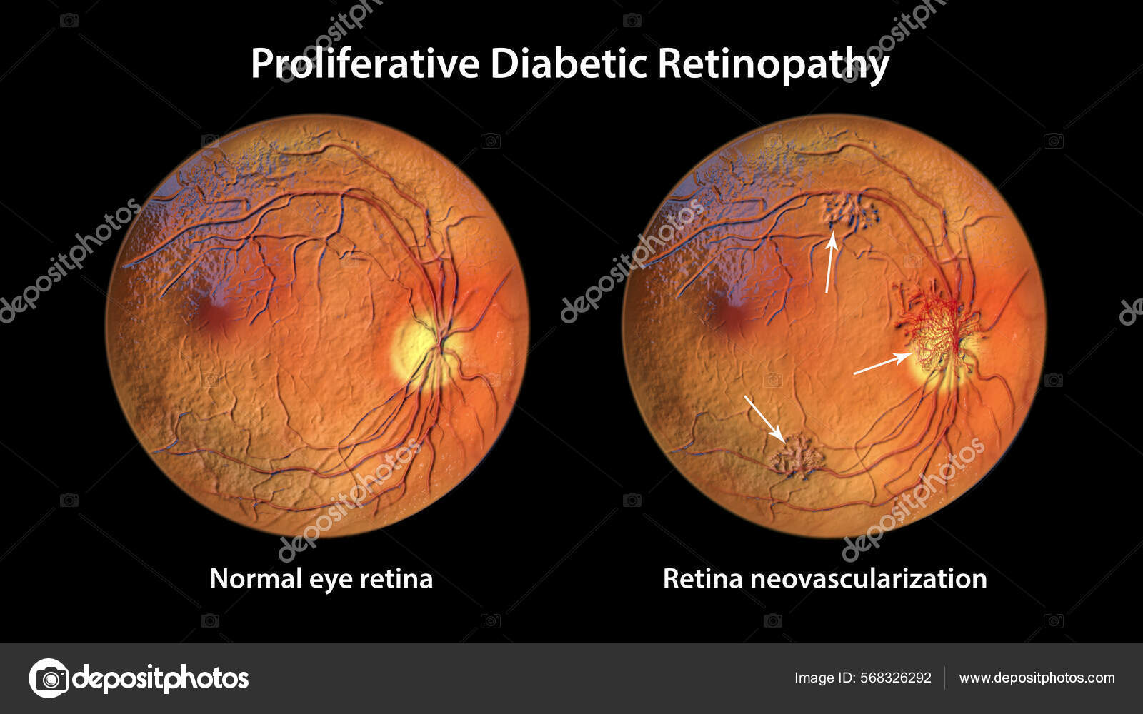 Retinopati Diabetik Proliferatif Ilustrasi Menunjukkan Neovaskularisasi ...