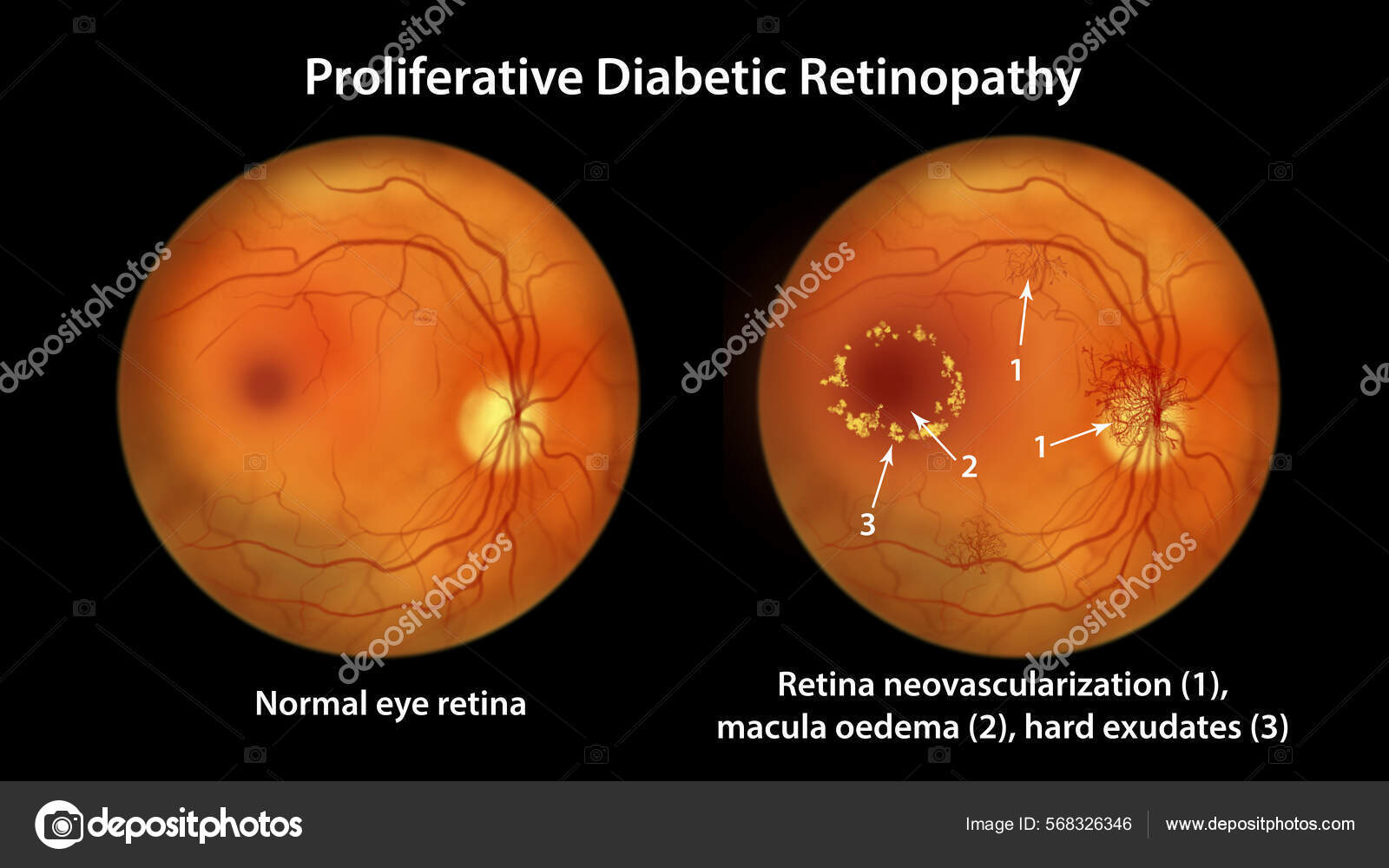 Retinopatia Diabetica Proliferativa Neovascularizacao