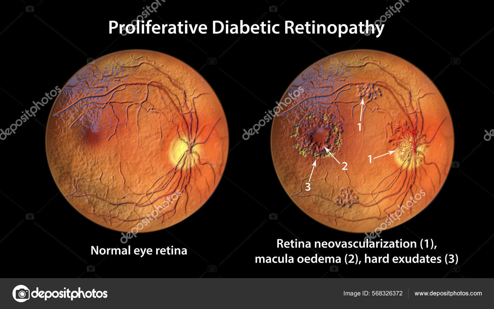 Retinopatía Diabética Proliferativa Ilustración Muestra ...