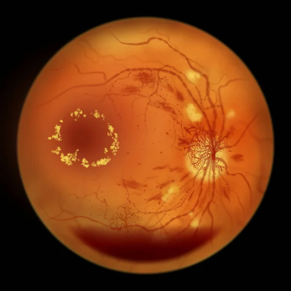 Proliferative Diabetic Retinopathy Illustration Showing ...