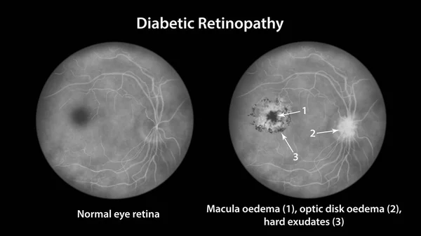 Diabetic Retinopathy Illustration Showing Macula Edema Hard Exudates ...