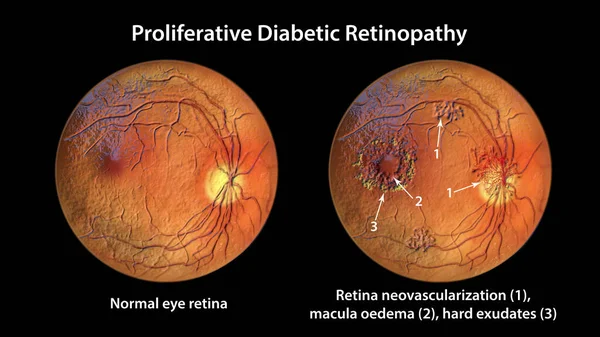 Diabetic Retinopathy Illustration Showing Macula Edema Hard Exudates ...