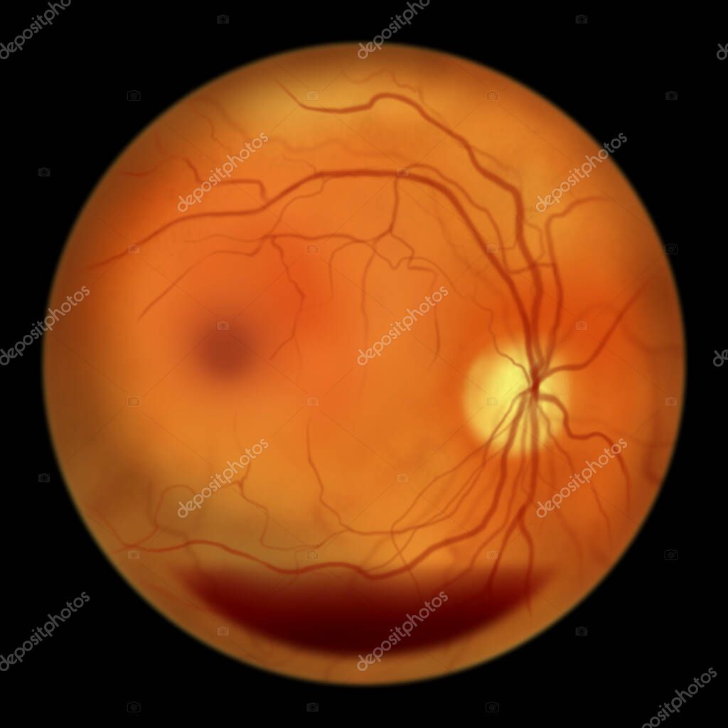 Retinopatía diabética, la ilustración muestra hemorragia preetinal como ...