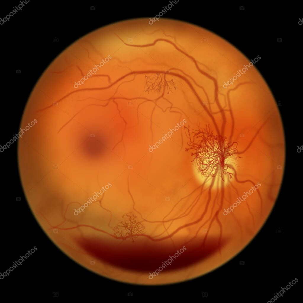 Proliferative diabetic retinopathy, illustration showing preretinal ...
